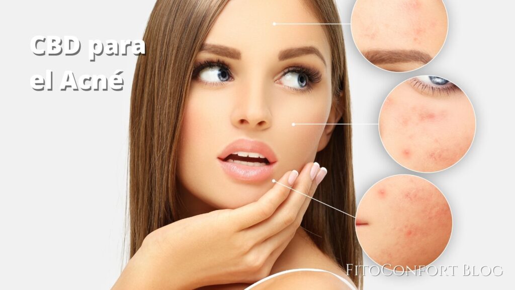 CBD para el Acné – FitoConfort